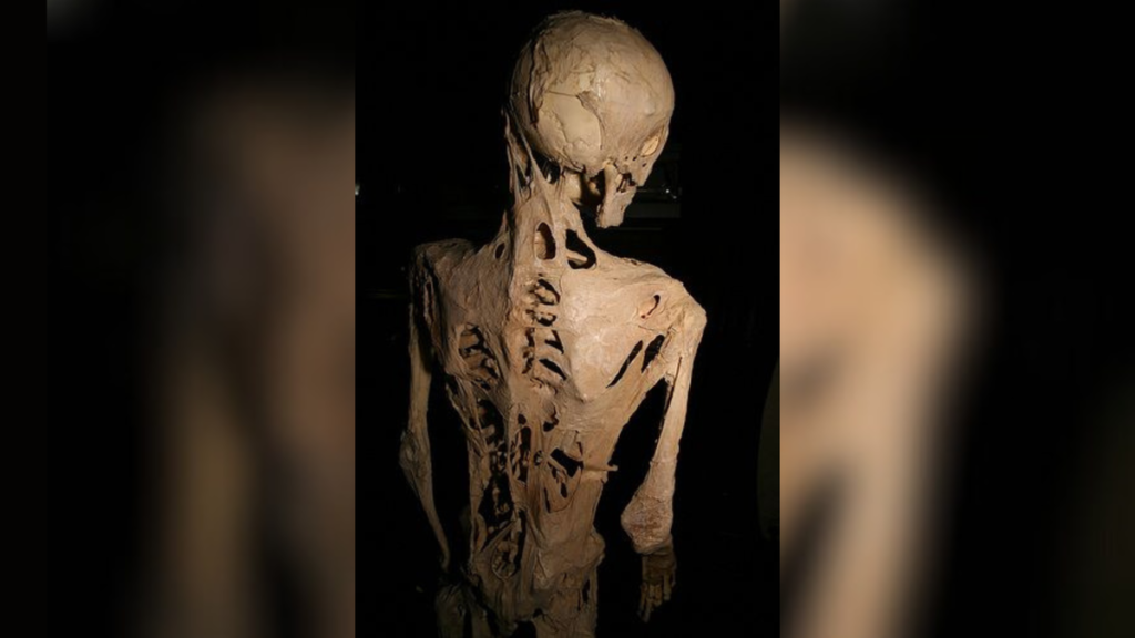 « Maladie de l'homme de pierre » : une maladie rare qui amène une ...
