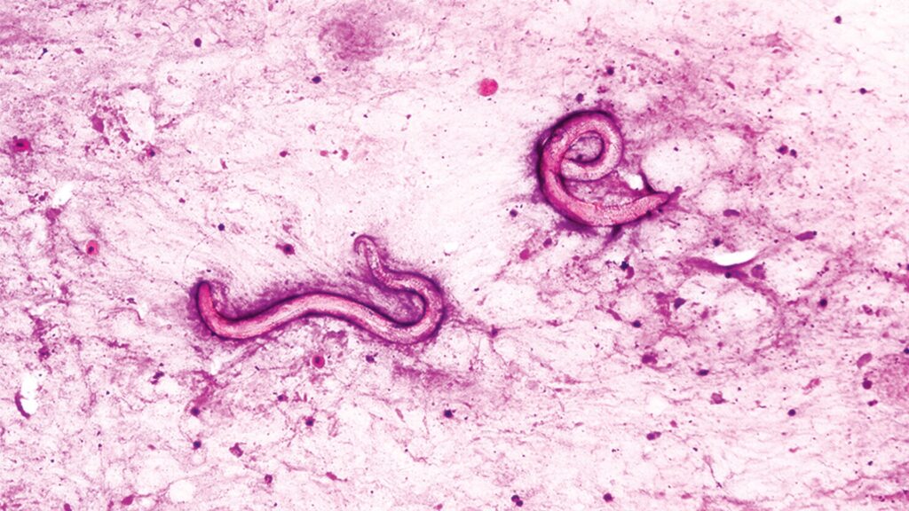 Le corps de l'homme rampe avec des vers parasites après une greffe de ...